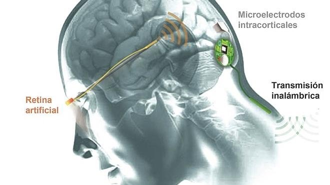 Implante cerebral a base de microelectrodos - Cortivis UMH